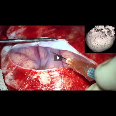 Icg Flow 800 Technology Targeted Sta Mca Microvascular Bypass For