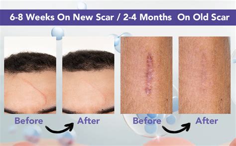 Advanced Silicone Scar Removal Cream For Keloid Bump