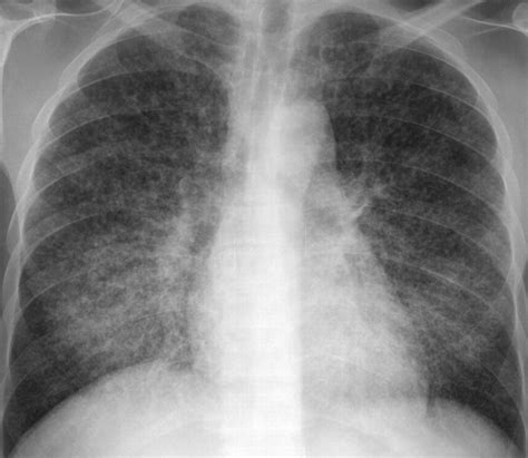 Tuberculosis Vs Pneumonia X Ray