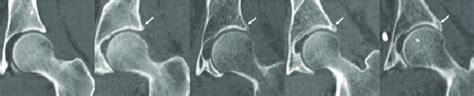 Coronal Reformats Of Ct Examinations Showing Different Sizes Of Labral
