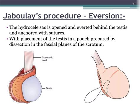 Approach To Scrotal Swellingpptx Infertility Reproductive Health