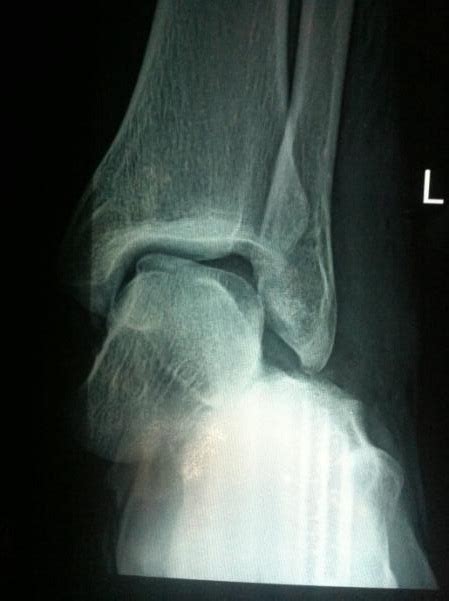 Lateral Subtalar Dislocation A Case Report The Foot And Ankle Online Journal