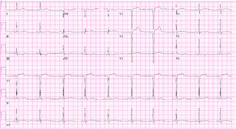 Improvement Noted In St Elevations Almost Complete Resolution Of St