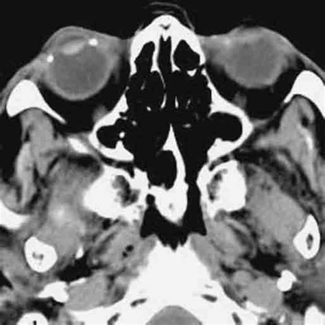 Dr Balaji Anvekar Frcr Orbital Calcifications