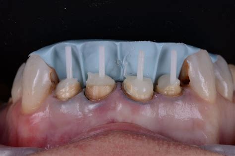 Vivardent Poste De Fibra De Vidrio