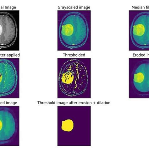 Tumor Feature Extraction After That The Algorithm Attempts To Correctly