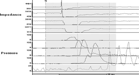 Clinical Relevance Of The Nutcracker Esophagus Suggested Re Journal Of Clinical