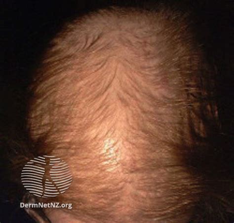 Androgenetic Alopecia Female The London Skin And Hair Clinic