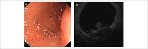 Duodenal Heterotopic Pancreas Misdiagnosed As Gist By Eus Eus
