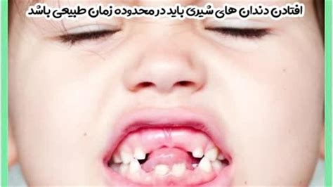افتادن زود هنگام دندان شیری کودکان نماشا