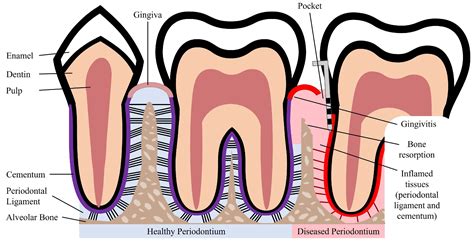 Currently Available Treatments For Periodontal Disease Encyclopedia Mdpi
