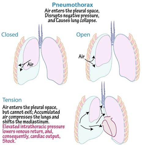 The Innovation Medicine On Twitter A Pneumothorax Is An Abnormal