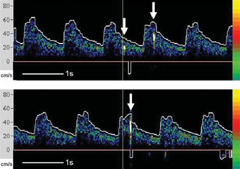 Transcranial Doppler Ultrasound Technique And Application Pdf