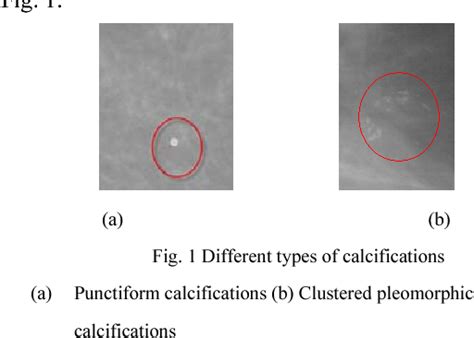 Figure 1 From Detection Of Clustered Pleomorphic Micro Calcifications In Digital Mammograms