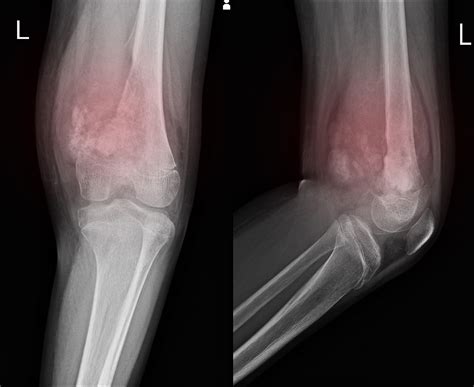 Bone Cancer Pictures Knee Bone Cancer Rohilkhand Cancer Institute