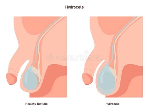 Hydrocele Swelling In The Scrotum Stock Vector Illustration Of Fluid Artery 271187540