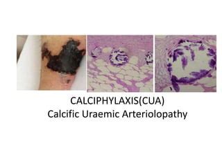 Calciphylaxis Skin Histology