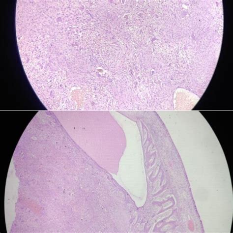 Histopathologic View Of Cgcg Showing Multinucleated Giant Cells