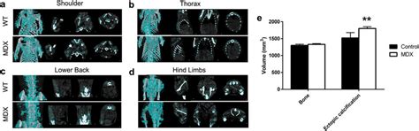 High Resolution Ct Based Segmentation Of Ectopic Calcification In The A Download Scientific