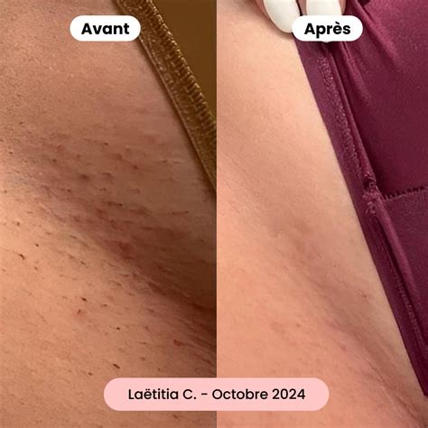 Best 13 Whats The Real Difference Between Brazilian And Bikini Waxes Artofit