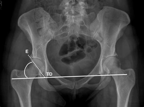Acetabular Index Or Acetabular Angle Of Sharp