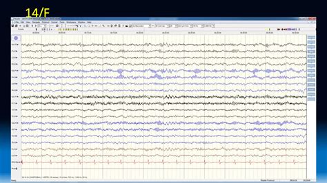 Normal Eeg Waveformspptx Brain And Nervous System Disorders