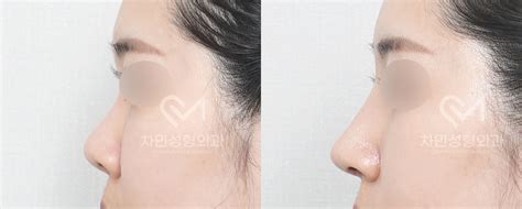 전후사진 1 페이지 나를 위해 선택한 차민성형외과