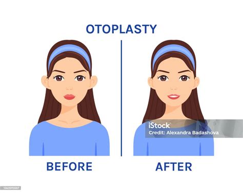 아름다운 여성 얼굴에 귀 오토성형 수술 전후 성형 수술 수술 예쁜 귀와 행복한 젊은 여자 플랫 카툰 컬러 스타일 흰색 배경입니다 벡터 그림입니다 갈색 머리에 대한 스톡 벡터