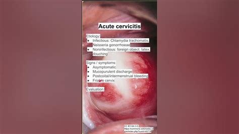 Acute Cervicitis Youtube