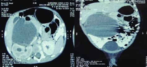Cect Abdomen Showing Mesenteric Cyst Download Scientific Diagram