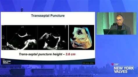 Case Presentation Iii Complex Case Of Pascal With Risk Of Inflow Gradient