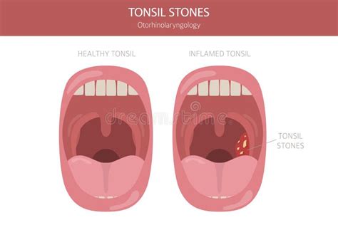 Tonsil Stones Diseases Otorhinolaryngology Chronic Caseous
