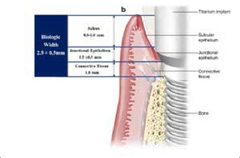 Soft Tissue Considerations Around Implants Download Scientific Diagram
