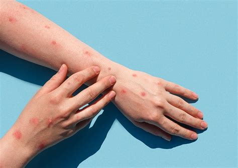 Similarities And Differences Between Chickenpox And Shingles