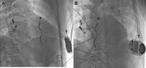 Implantation Of An Extravascular Implantable Cardioverter Defibrillator