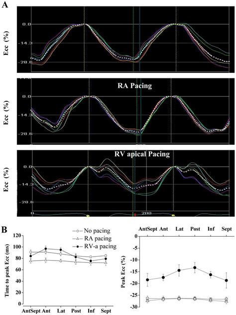 Segmental Ecc Analysis During Ra And Rv Pacing A Representative