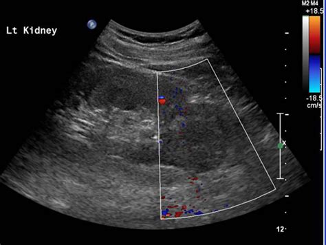 A Case Of Asymptomatic Renal Pseudoaneurysm Post Partial Nephrectomy