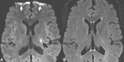 Diffusion Weighted Imaging Radiology Key