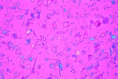 polarized light microscopy crystals