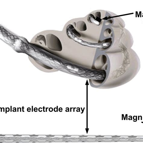 Cutaway View Of A Cochlea With An Inserted Electrode Array Photo By Download Scientific