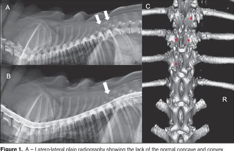 Constrictive Myelopathy Secondary To Caudal Articular Vertebral Process