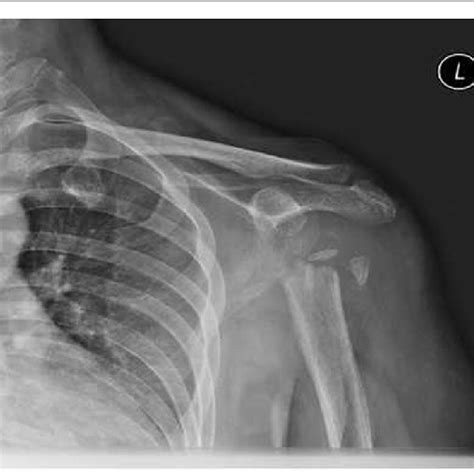 Walch Classification Of Glenoid Morphology In Primary Glenohumeral