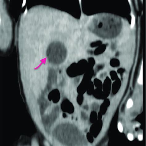 Ct Scan Of The Abdomen Demonstrates A Large Cystic Mass In The Hilum Of