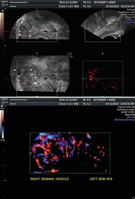 Diffusion Weighted Whole Body Imaging Tumor Staging Applications Radiology Key