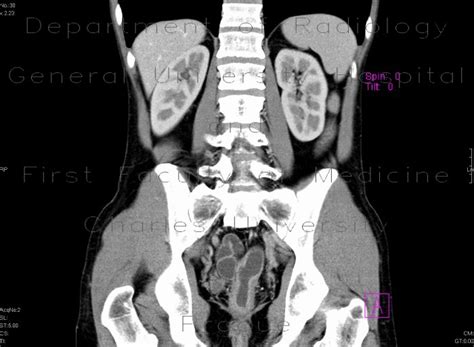 Radiology Case Crohns Disease Ileocecal Resection Subtotal