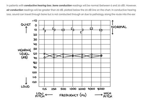 Solved On The Audiogram Below Indicate The Degree Configuration And Course Hero