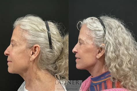 Deep Plane Facelift Neck Lift Page 4 Ladner Facial Plastic Surgery