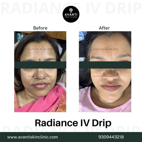 Glutathione Injection Before And After Glutathione Injection For Skin