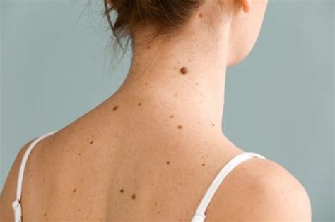 Descubre Todos Los Tipos De Melanoma Clínica Multilaser