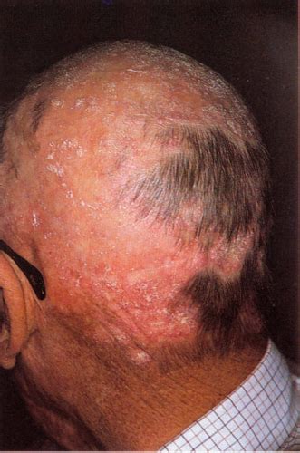 Alopecia Flashcards Quizlet